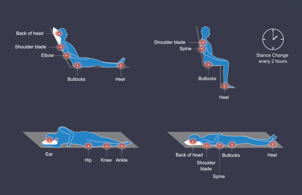 Pressure Ulcers - Alzheimer's Los Angeles